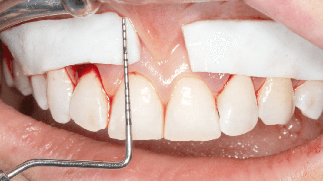 NovoMatrix® Soft tissue regeneration – CAMLOG Biotechnologies GmbH