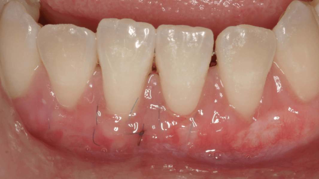 NovoMatrix® Soft tissue regeneration – CAMLOG Biotechnologies GmbH