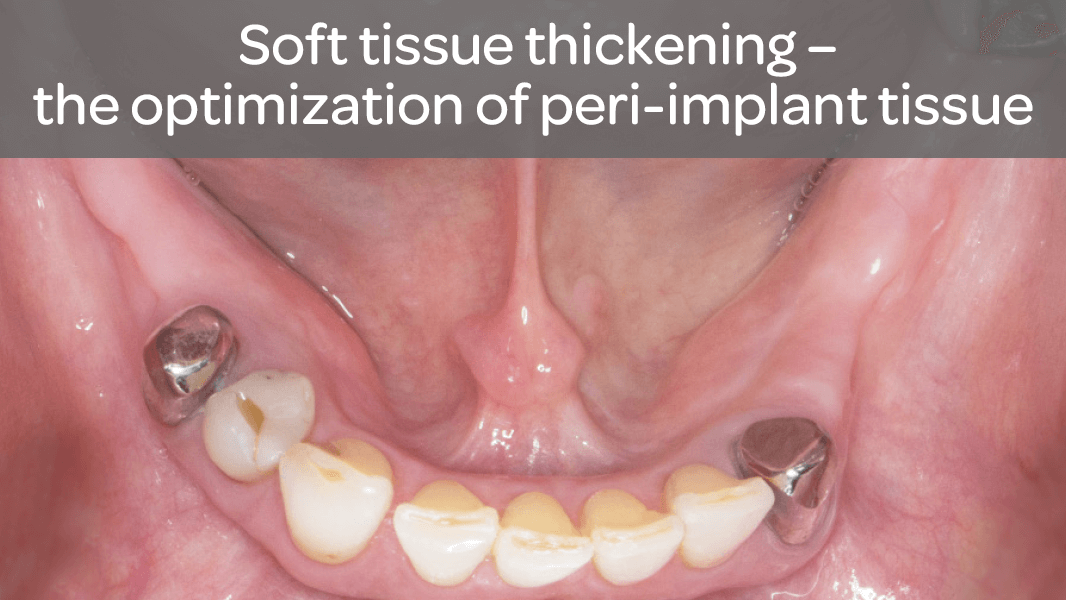 NovoMatrix® Soft tissue regeneration